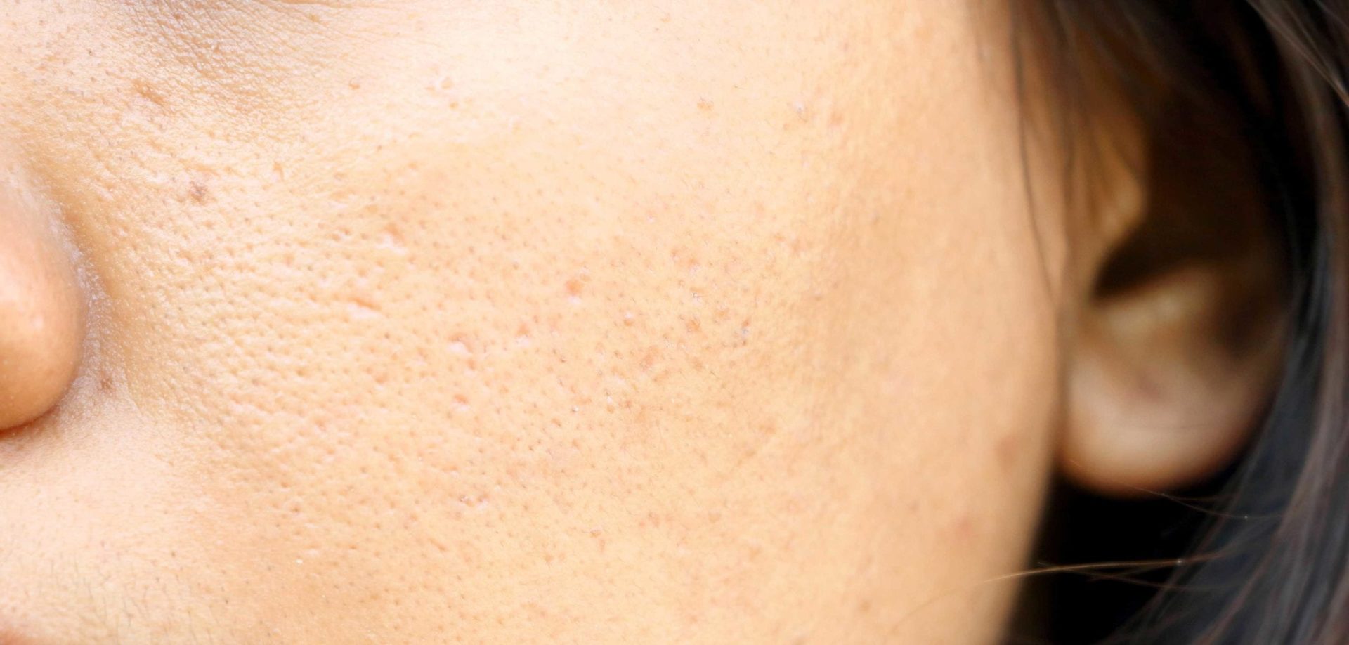 Enlarged Pores Cosmetic Medical Clinic - CMC - Sydney | CMC | Cosmetic ...