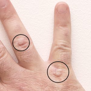 wart_before3 | CMC | Cosmetic Medical Clinic